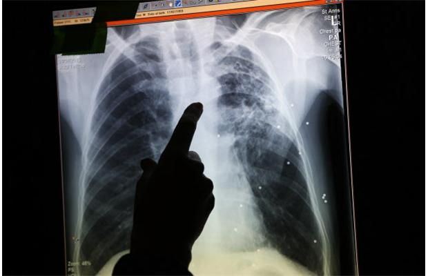 Alberta sees increase in cases of drug-resistant tuberculosis, report ...