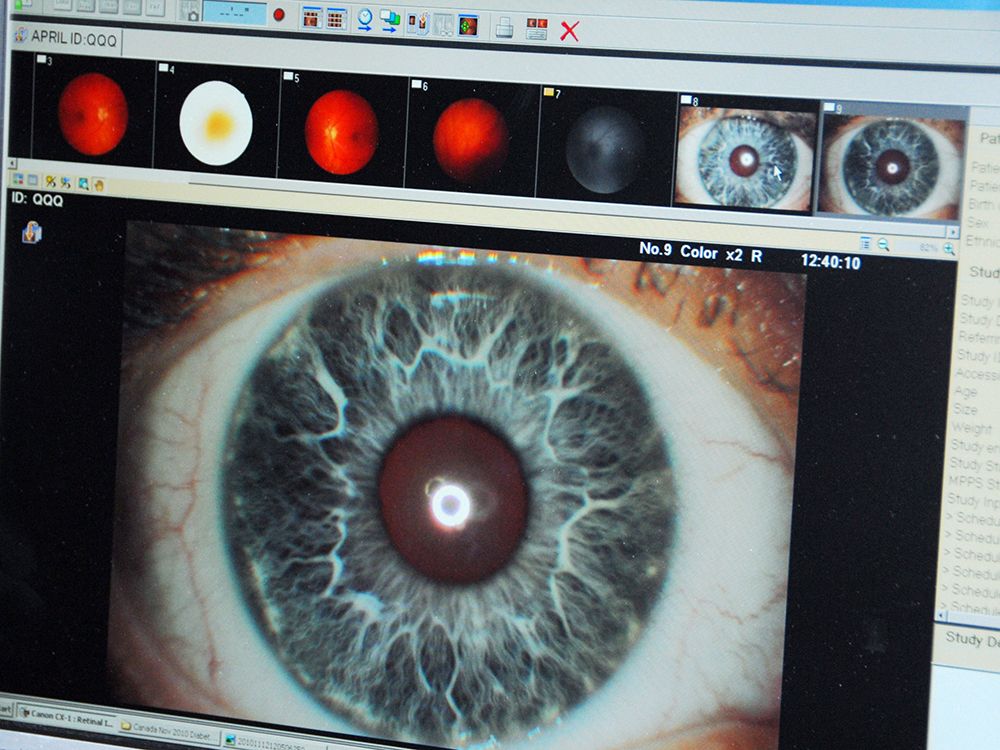 Alberta expands drug access program for patients with retinal problems ...