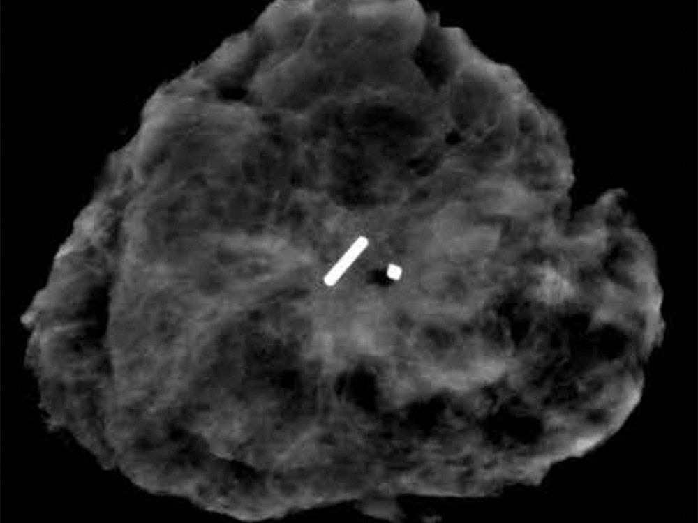 Calgary surgeons taking radioactive edge off breast cancer treatment ...