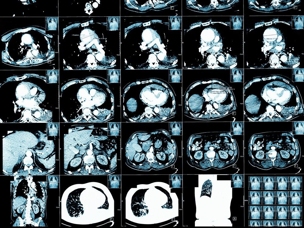 Canadian Cancer Society take aim at lung cancer deaths | Calgary Herald