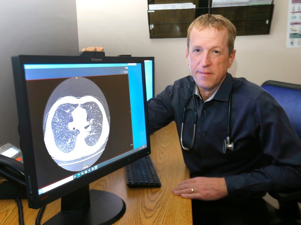 Alberta lung cancer screening pilot could lead to more early detection | Edmonton Journal