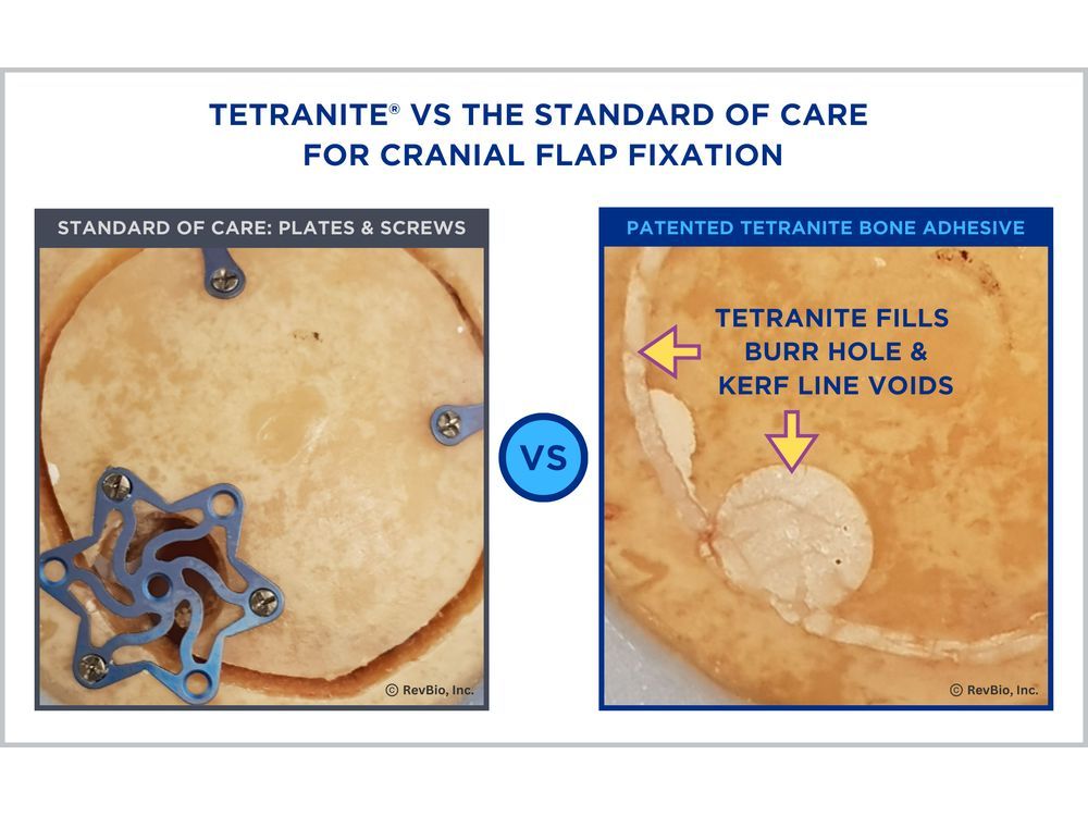RevBio Receives FDA Approval to Conduct a First-in-Human Clinical Trial ...