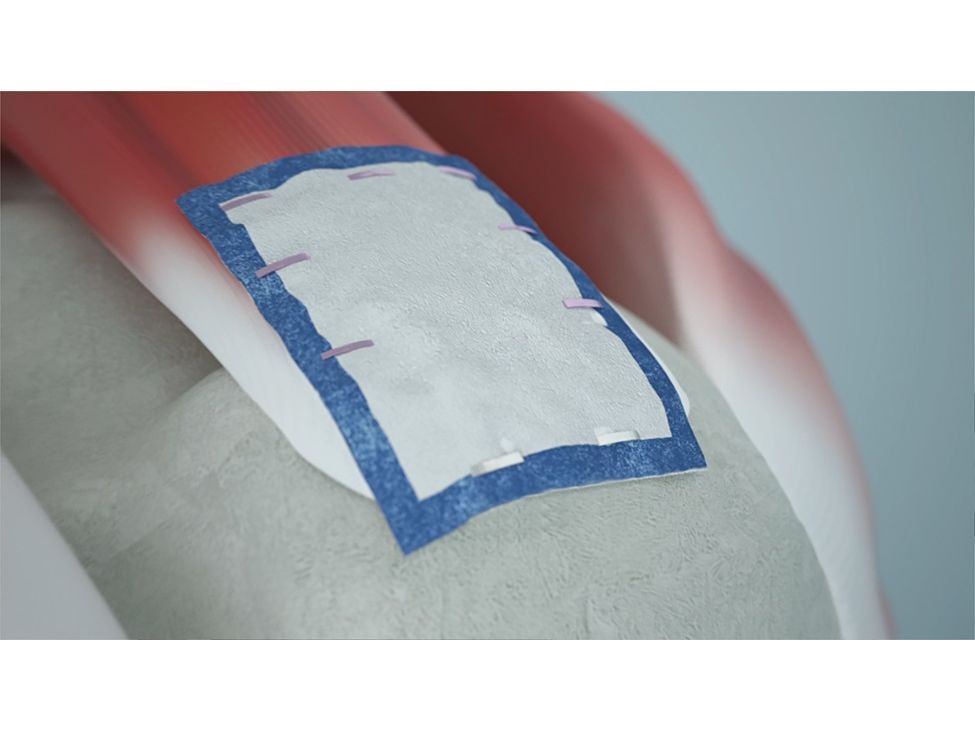 New study confirms Smith+Nephew's REGENETEN™ Bioinductive Implant ...