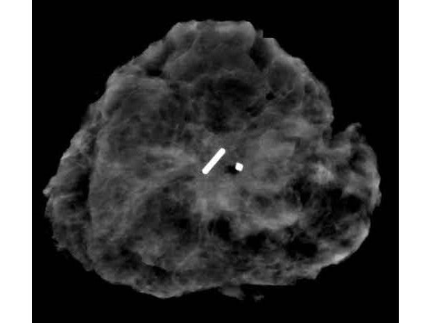 Ground-breaking pilot project poised to transform breast cancer surgery ...