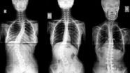 What Are The Symptoms Of Scoliosis Healthing ca