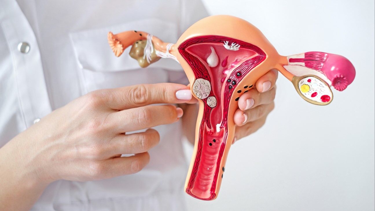 What are uterine fibroids? What you need to know about causes, symptoms ...