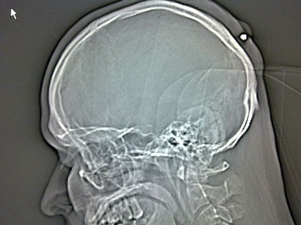Drunk Polish man takes a bullet to the head, notices five years later ...