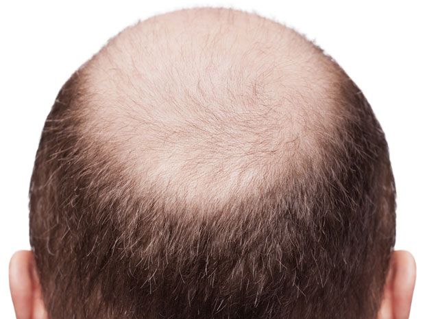 Skin molecules that cause baldness, unwanted hair identified as U.S ...