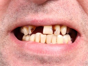 American teeth are as bad as British teeth, study says | National Post