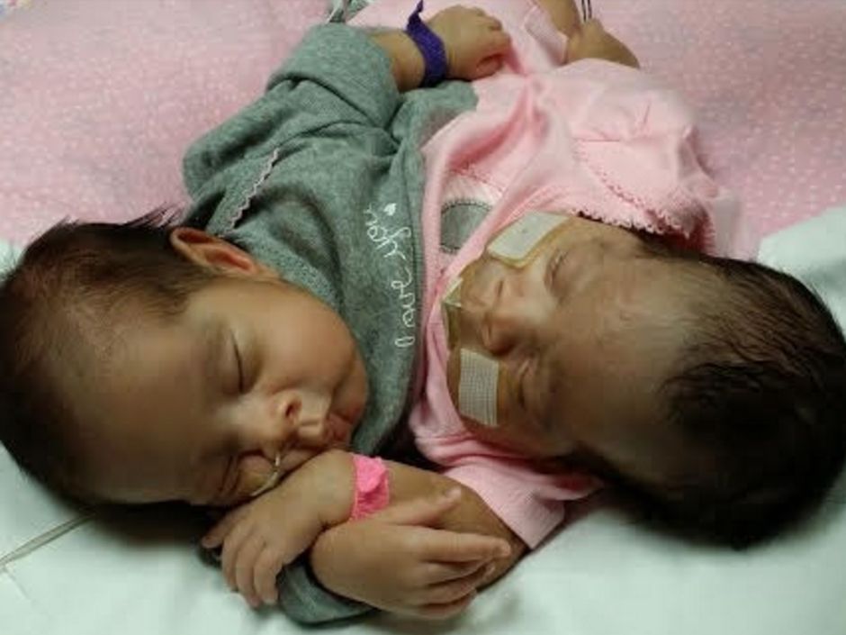 Doctors use 3-D printing to prepare for 26-hour surgery to save twins ...