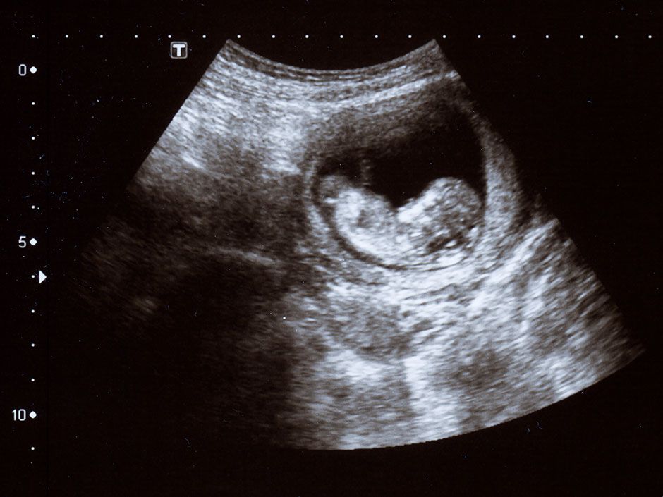 Mike Schouten: A new bill would make it a crime to harm a fetus against ...