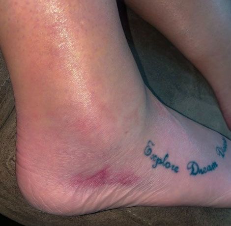 Dr. Andy Reed - RICE or MEAT? Which is best for you? | Bow Valley Crag ...