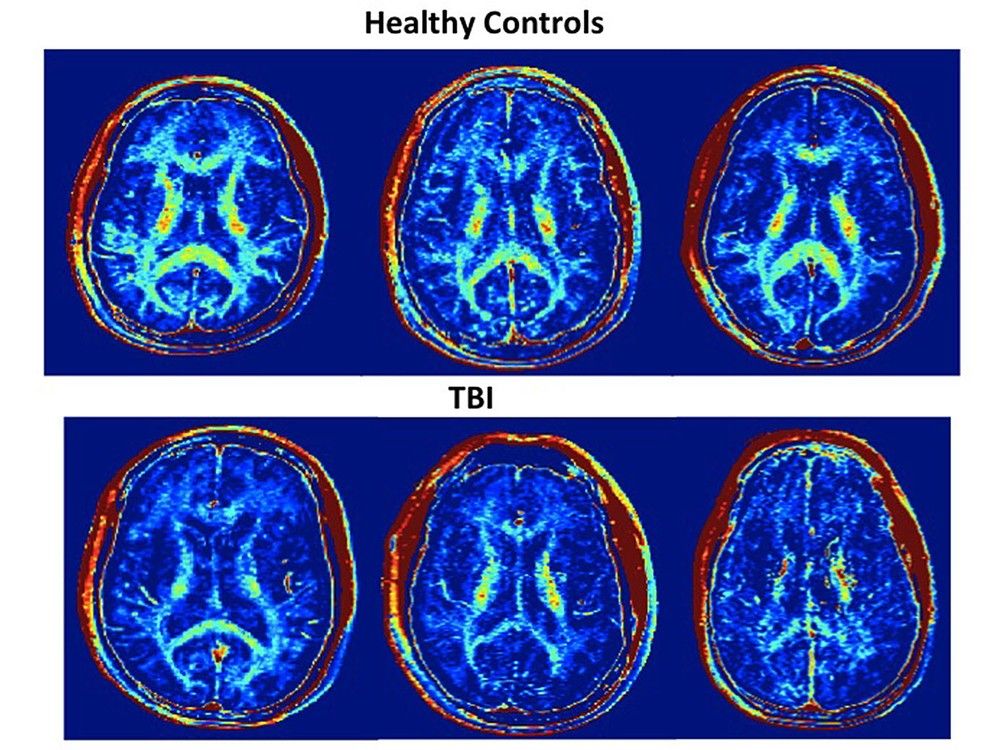 UBC researchers seek $2M for ground-breaking brain-injury study ...