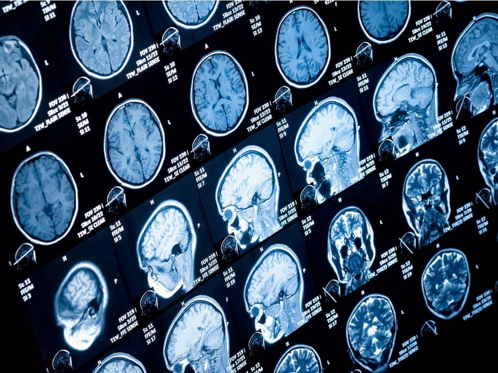 Research could lead to easily accessible test for schizophrenia ...