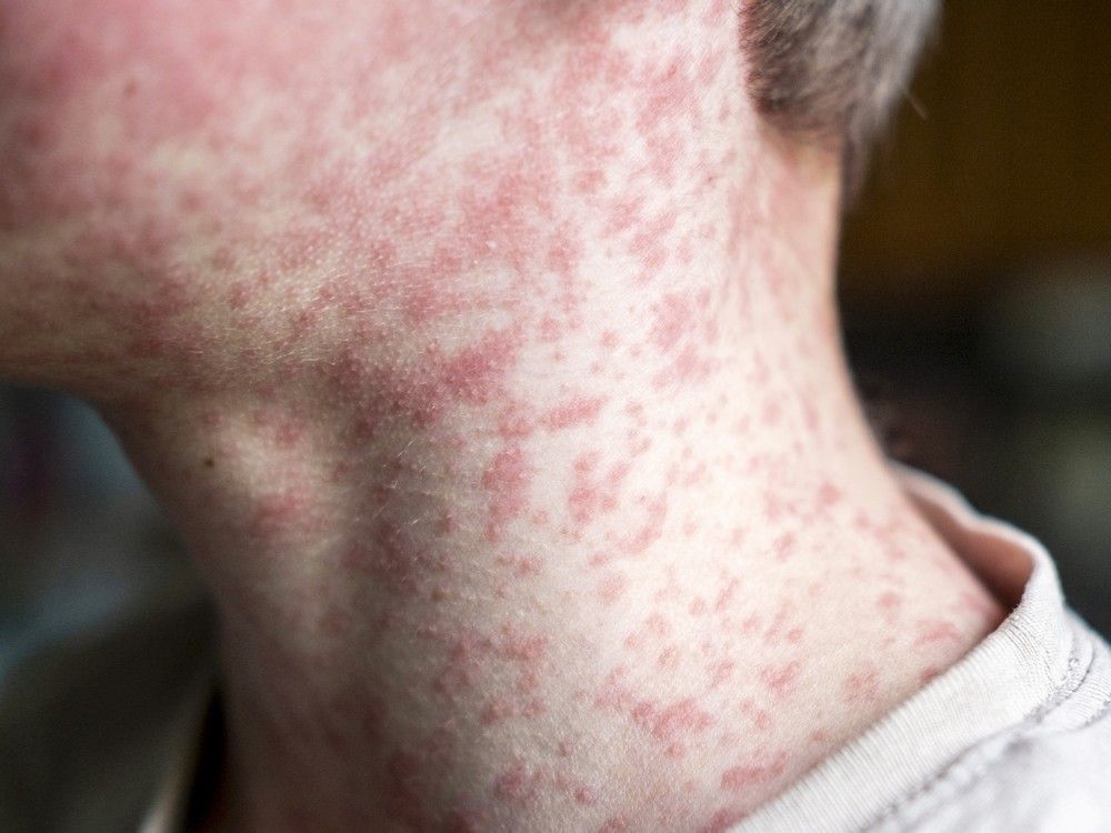YOU SAID IT: Measles 'diagnosis' upsetting | Ottawa Sun