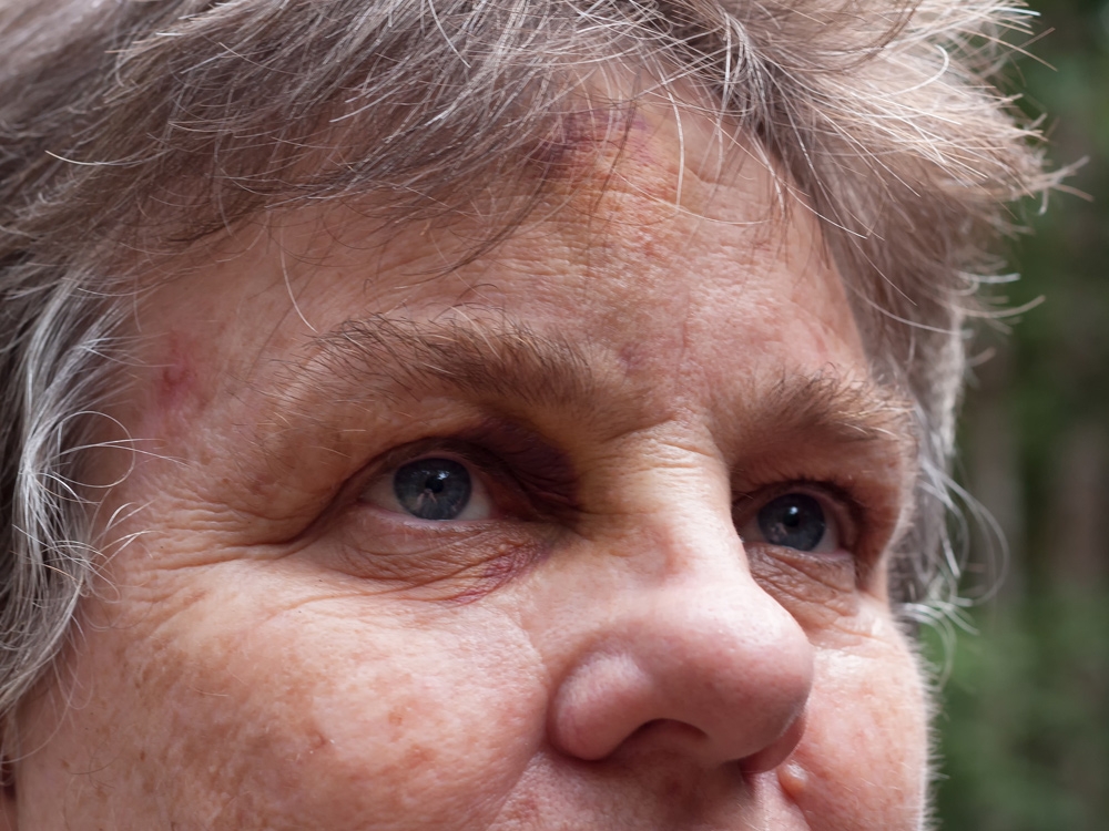 Face forward: Facial fractures on the rise | Toronto Sun