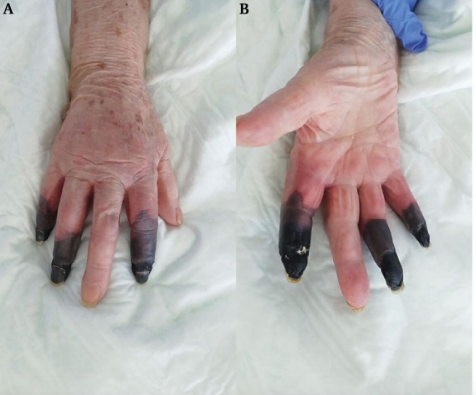 Elderly Italian woman gets gangrene, black fingers from COVID-19 ...