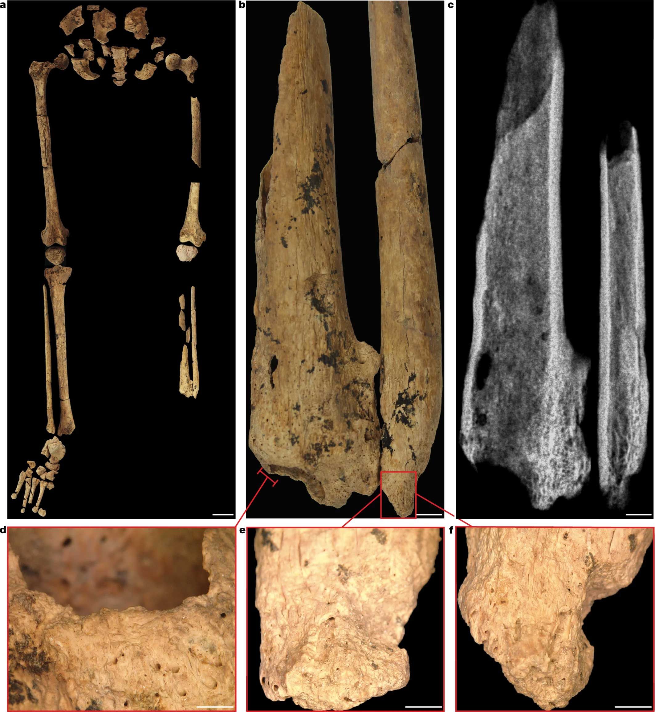 Stone Age skeleton missing foot may show oldest amputation | Toronto Sun