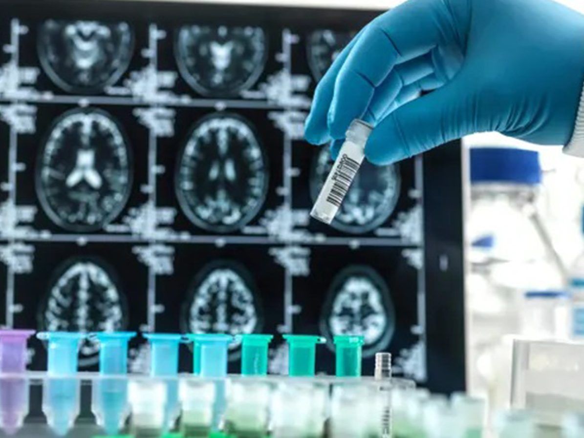 Drug slows Alzheimer's but can it make a real difference? | Toronto Sun