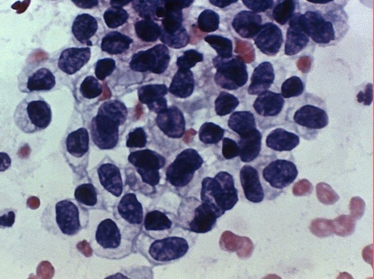 Ontario shifts from Pap to HPV test for cervical cancer screening ...