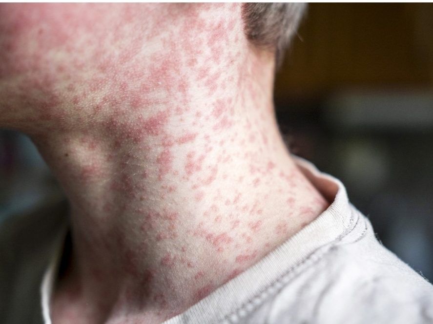 Infant born prematurely dies after measles infection | Toronto Sun