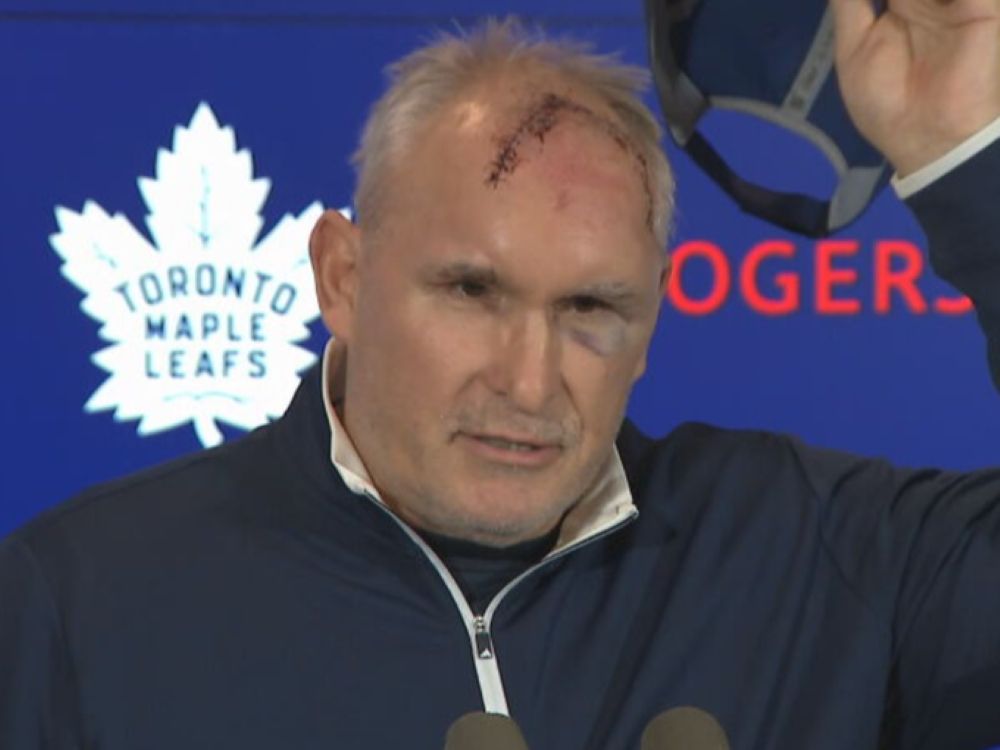 Craig Berube shows off gruesome injuries after gym mishap | Toronto Sun