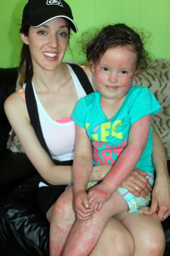 Local mom looking for more sensitivity for her daughter's rare skin ...