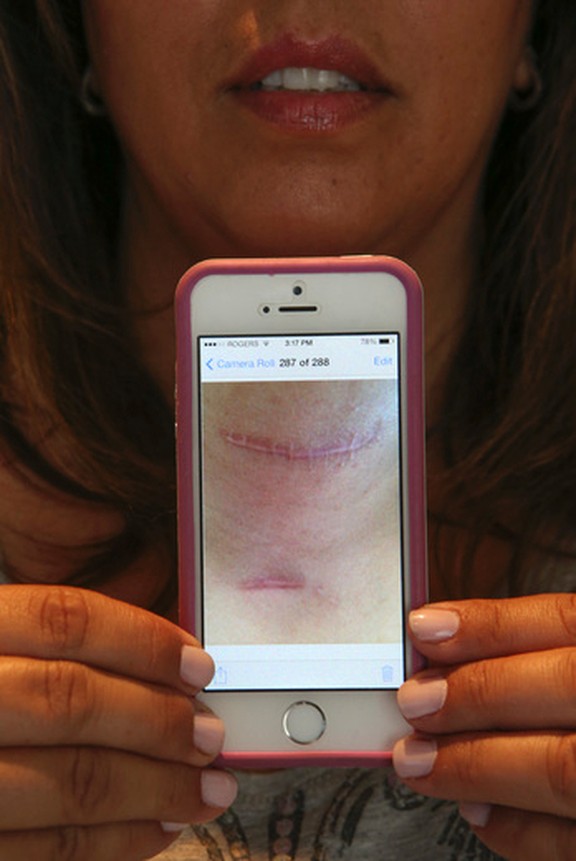 Bbq Bristle Lodged In Toronto Womans Throat Toronto Sun