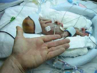 Micro-preemies face big battles early in life | Toronto Sun