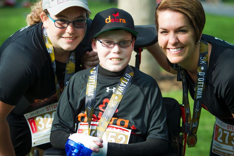 'Butterfly child' Jonathan Pitre pushes through pain to do 5K at Ottawa ...