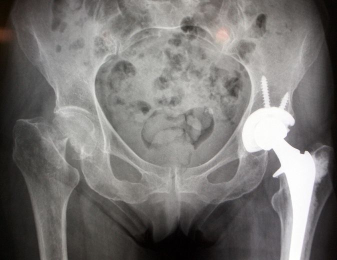 Broken hips less deadly in larger hospitals: Study | Toronto Sun