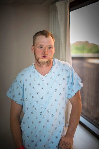 Twin tragedies give survivor Andy Sandness a new face | Toronto Sun