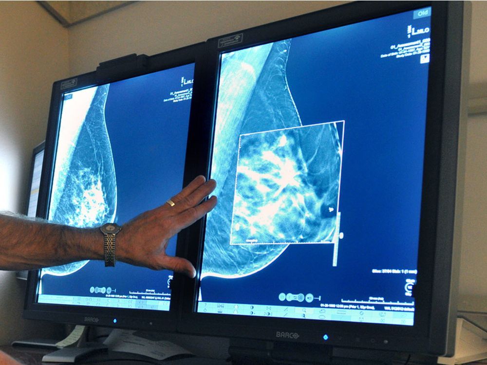 B.C. women first in Canada to get breast density info with cancer ...